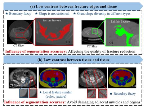 some difficult samples of pelvic ct slices a low contrast between download scientific