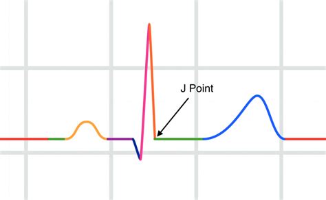 Interpreting ST Elevations On An ECG Electrocardiogram