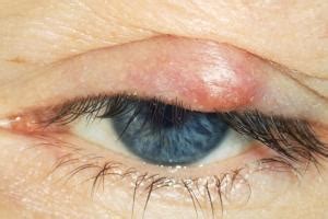 Stye Nidirect