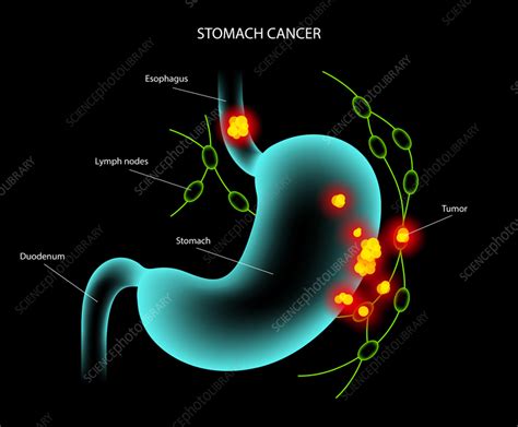 Stomach Cancer Illustration Stock Image F0363906 Science Photo