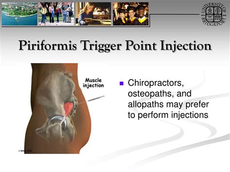 Myofascial Injections Trigger Point Piriformis Iliops Vrogue Co