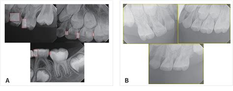Table 2 From Assessment Of The Object Detection Ability Of Interproximal Caries On Primary Teeth