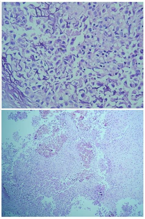 Histopathology Showing Cobblestone Arrangement Of Chondrocytes On A