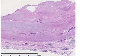 Syphilitic Aortitis Mimicking Takayasus Arteritis
