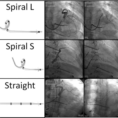 Pacing Capture Threshold Comparison Between Electrodes The Pacing Download Scientific Diagram