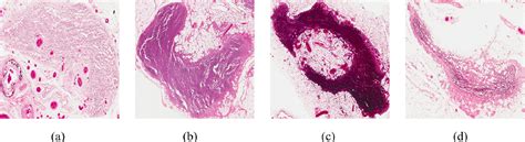 Figure 1 From Automatic Lymph Node Classification With Convolutional