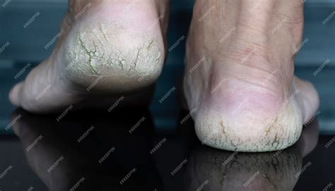 Premium Photo Close Up Cracked Heel Further Deep Cracks And Dry Flaky