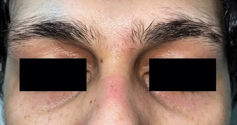 Current Understanding Of Frictional Dermatoses A Review Indian Journal Of Dermatology