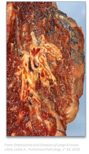 Obstructive Lung Disease Copd And Brinchiectasis Flashcards Quizlet