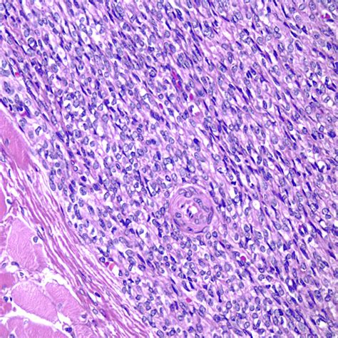 Synovial Sarcoma Foot And Ankle