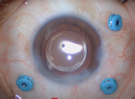 Vitrectomy Top Of The Line Experience And Medical Equipment