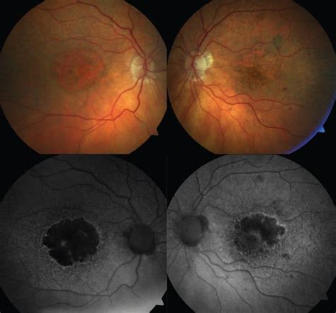 Macular Degeneration Association On Linkedin Geographic Atrophy