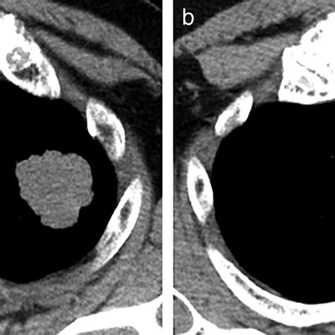 Chest Computed Tomography In Axial Slices A Before And B After
