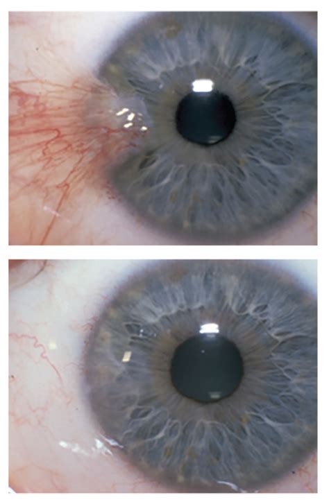 Pterygium Excision With Graft Cpt Excision Of Pterygium Ldhwo