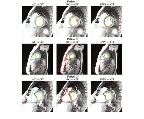 Left Ventricle Segmentation Compared To The Ground Truth Segmentation Download Scientific