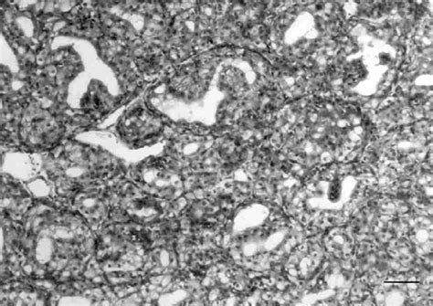 Microscopic Appearance Of Hyperplastic Goitre Bar 60 μ Download