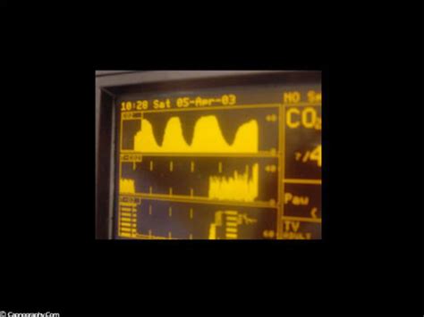 Capnograms During Procedural Sedation Capnography