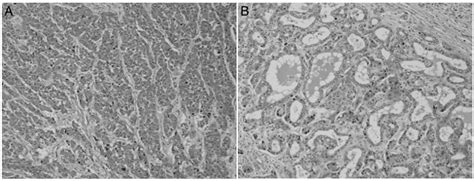 Combined Hepatocellular Cholangiocarcinoma Associated With Radiofrequency Ablation For
