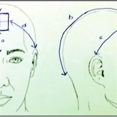 Area On Vertex Of The Scalp To Be Used For Hair Count Same Distance Download Scientific
