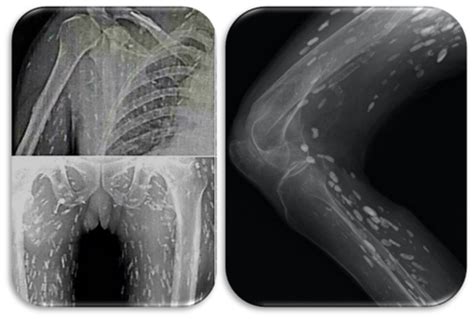 Tapeworms Flashcards Quizlet