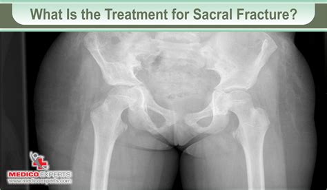 Sacral Fracture Treatment Regain Mobility And Comfort Fast