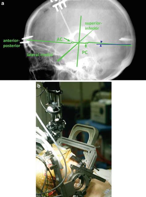 Techniques Of Stereotactic Localization Radiology Key