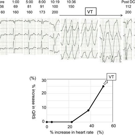 The Serial Ecgs From 2 Years Prior When She Was Diagnosed With Download Scientific Diagram
