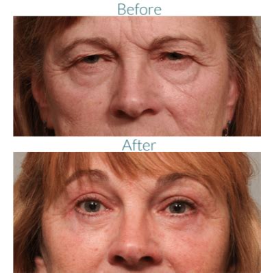 Blepharoplasty Recovery Time Fante Eye And Face Center