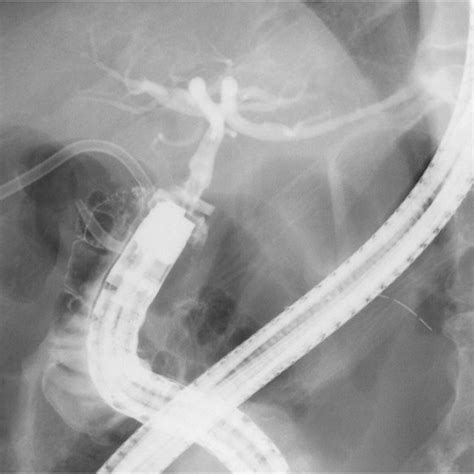 Preoperative Endoscopic Retrograde Cholangiopancreatography Image Download Scientific Diagram