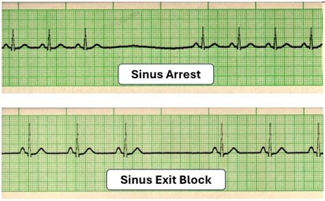 Ekg Detective Sinus Arrest Vs Sinus Exit Block