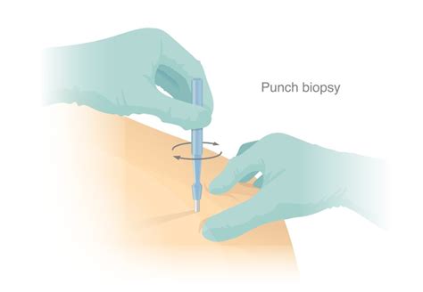 Small Fiber Neuropathy Causes And Treatment Suzy Cohen Rph Offers Natural Remedies To Help