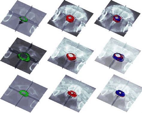 Deformable Registration Results Of Laplacian Surface Deformation And
