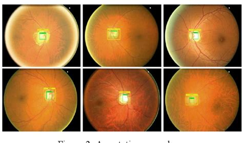 Figure 3 From An Automated Glaucoma Detection From Fundus Images Based