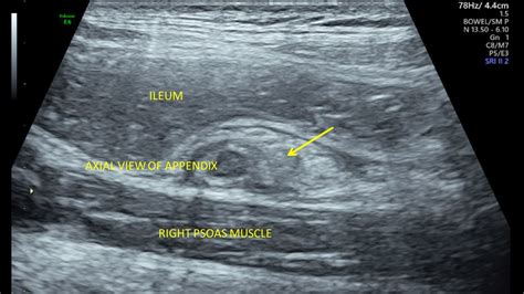 Acute Appendicitis Ultrasound YouTube