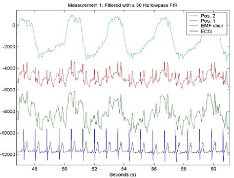 Measurement 1 From The Chest During Normal Respiration Signals Shown Download Scientific