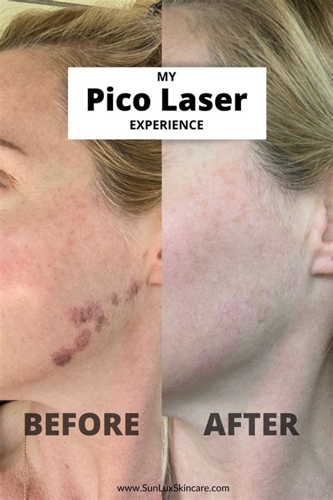 The Good And Bad Of Pico Laser Treatment Sunlux Skincare