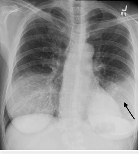 Reticular Chest X Ray