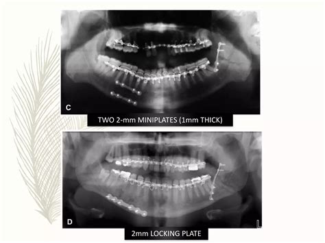 Open Reduction And Internal Fixation Of Combined Angle And Body Symphysis Fractures Of The