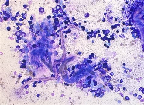 Mast Cell Tumor In Dogs Cytologic Grading Of Canine Mast Cell Tumours