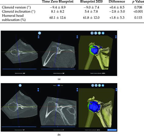 Glenoid And Joint Alignment Measurements Achieved With Time Zero Download Scientific Diagram