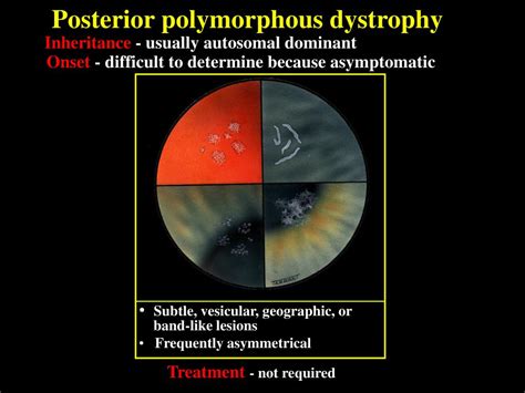 Ppt Corneal Dystrophies Powerpoint Presentation Free Download Id
