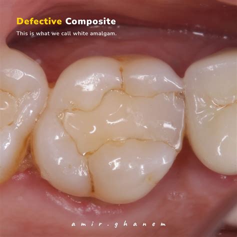 Amir Ghanem On Linkedin Biomimetic Composite Compositerestoration Directcomposite