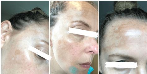 What Is The Difference Between Melasma And Hyperpigmentation Hedox Clinic