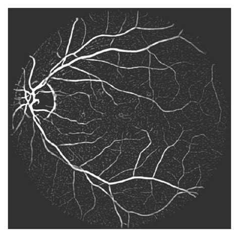 An Example Of The Multiscale Hessian Based Enhancement Of Figure 1 The