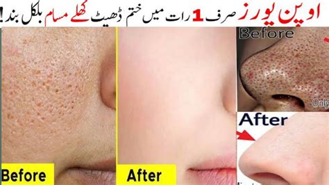 How To Close Open Pores On Face Permanently How To Get Rid Of Larg Pores Open Pores