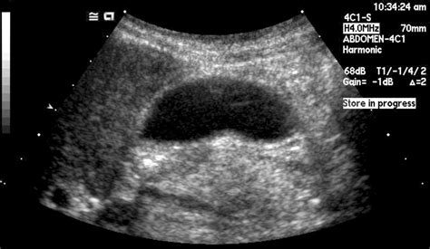 Chronic Cholecystitis Ultrasound
