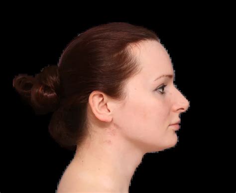 Hairline Feminization Surgery — Facialteam