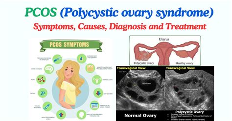 Ultrasound Polycystic Ovary Syndrome