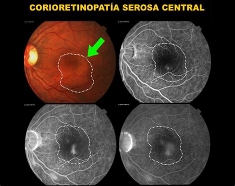 Coroidopatía Serosa Central Somos Retina Y Mácula Consultores