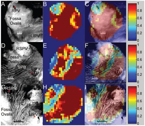 Atrial Septopulmonary Bundle Of The Posterior Left Atrium Provides A Substrate For Atrial
